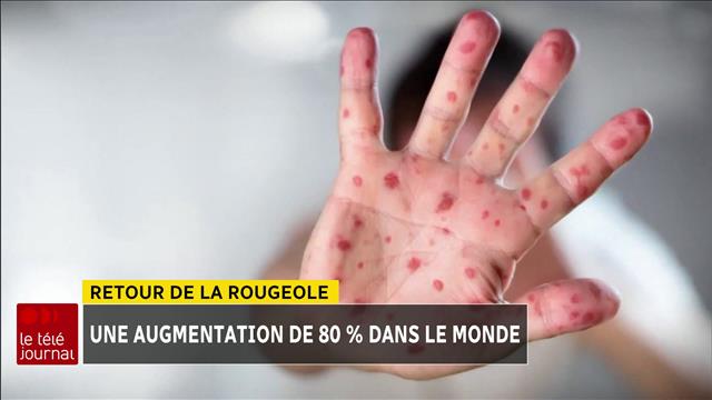 Retour de la rougeole : trois nouveaux cas au Québec | Info | Radio-Canada