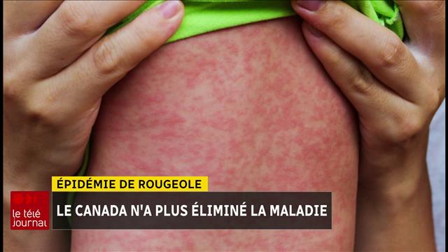 Le Canada perd son statut d’élimination de la rougeole | Radio-Canada